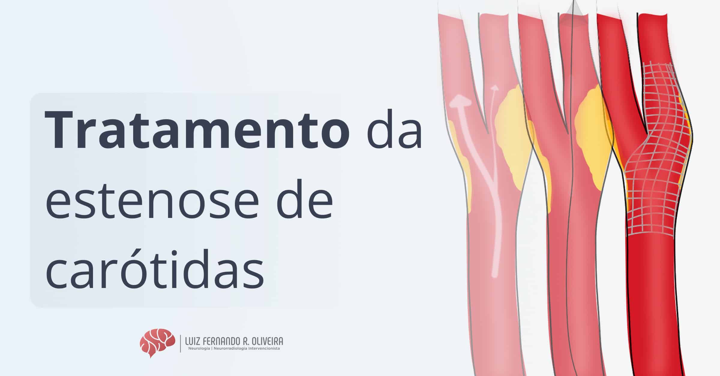Angioplastia da carótida com stent - Tratamento da doença carotídea
