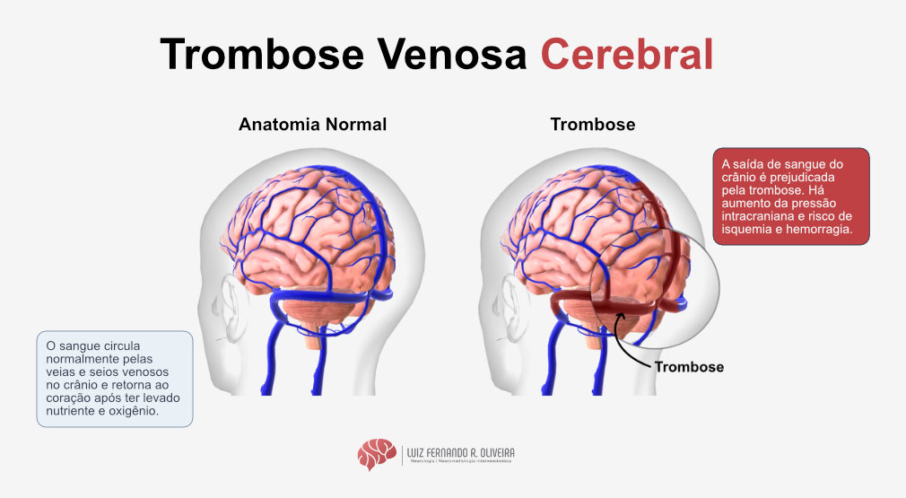 Trombose Venosa Cerebral: sintomas, causas, tratamento, sequela